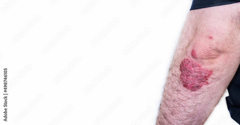 Psoriasis. Autoimmune genetic disease. A man with sore hands, dry flaky ...
