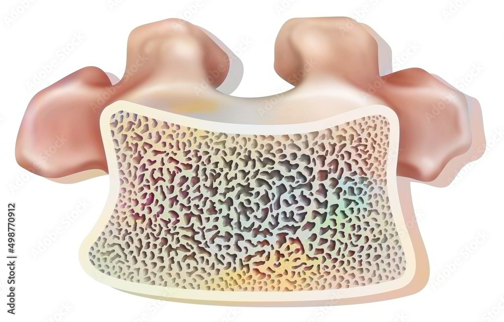 Structure of a healthy dorsal vertebra with spongy and compact tissue ...