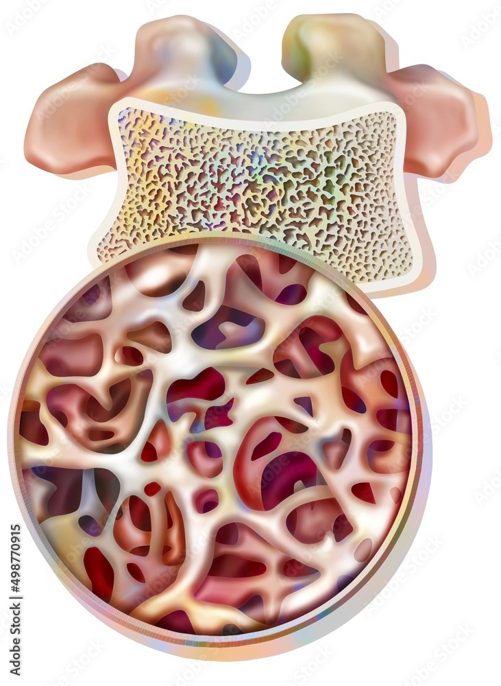 Structure of a healthy dorsal vertebra with spongy and compact tissue ...