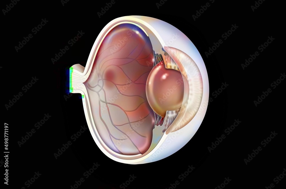 Eye: age-related macular degeneration (degenerative disease. Stock ...