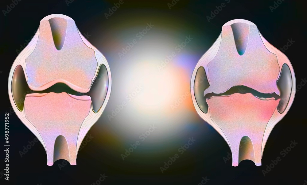 Anatomy of the joint of a healthy knee on the left. Stock Illustration ...