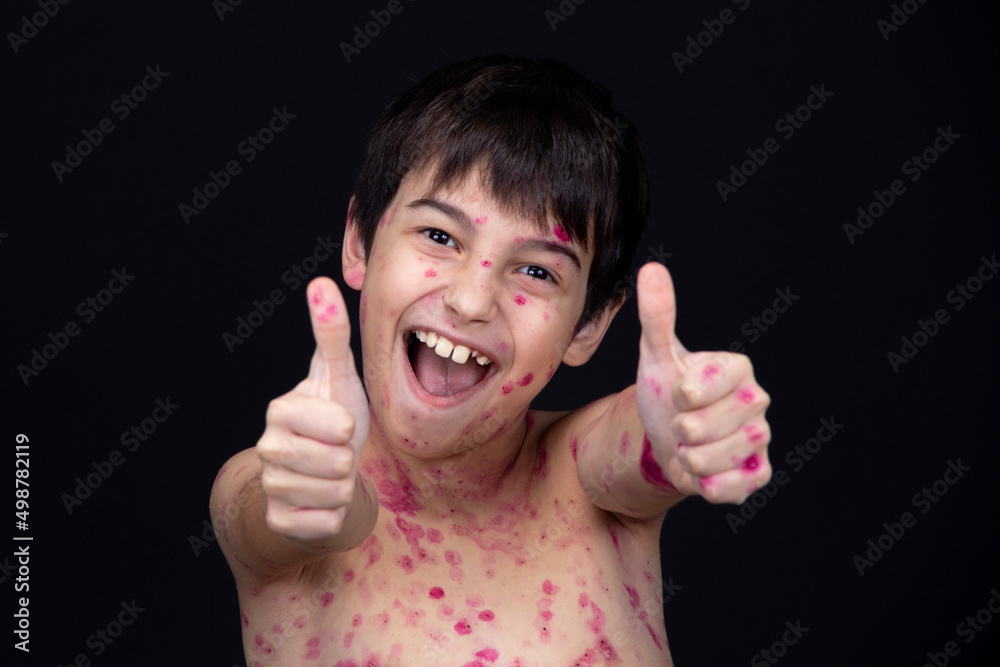 Chickenpox virus. Skin rash in a child. Thumbs up. 8 year old boy Stock ...