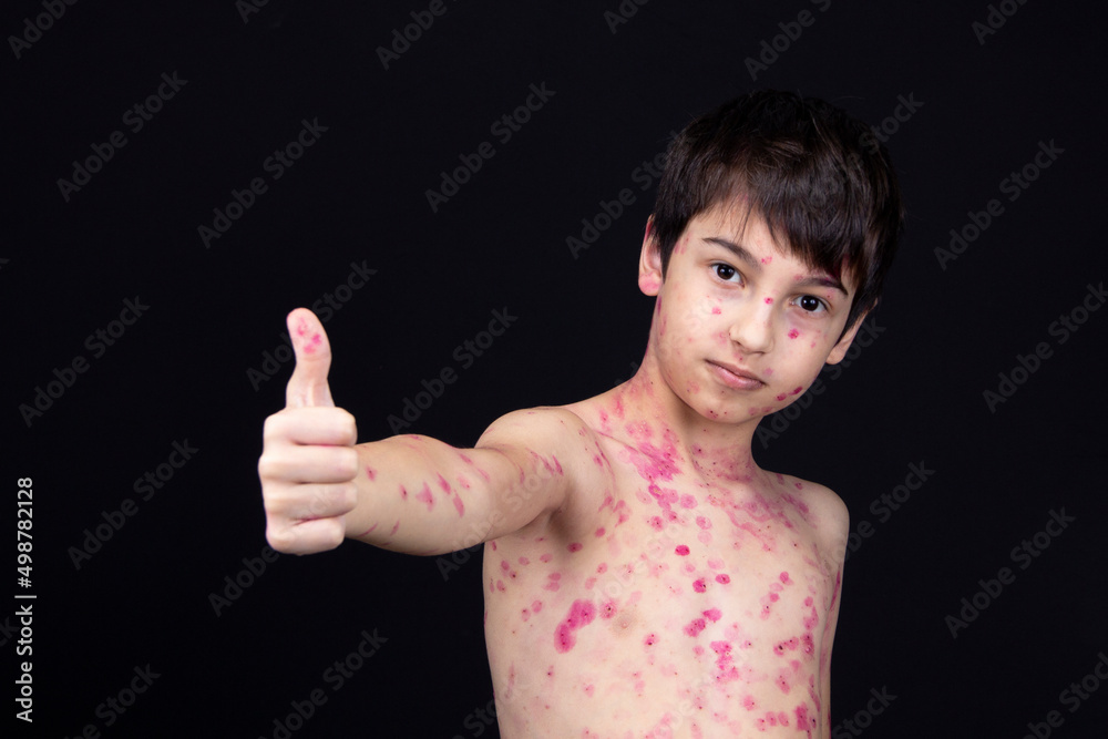 Chickenpox virus. Skin rash in a child. Thumbs up. 8 year old boy Stock ...