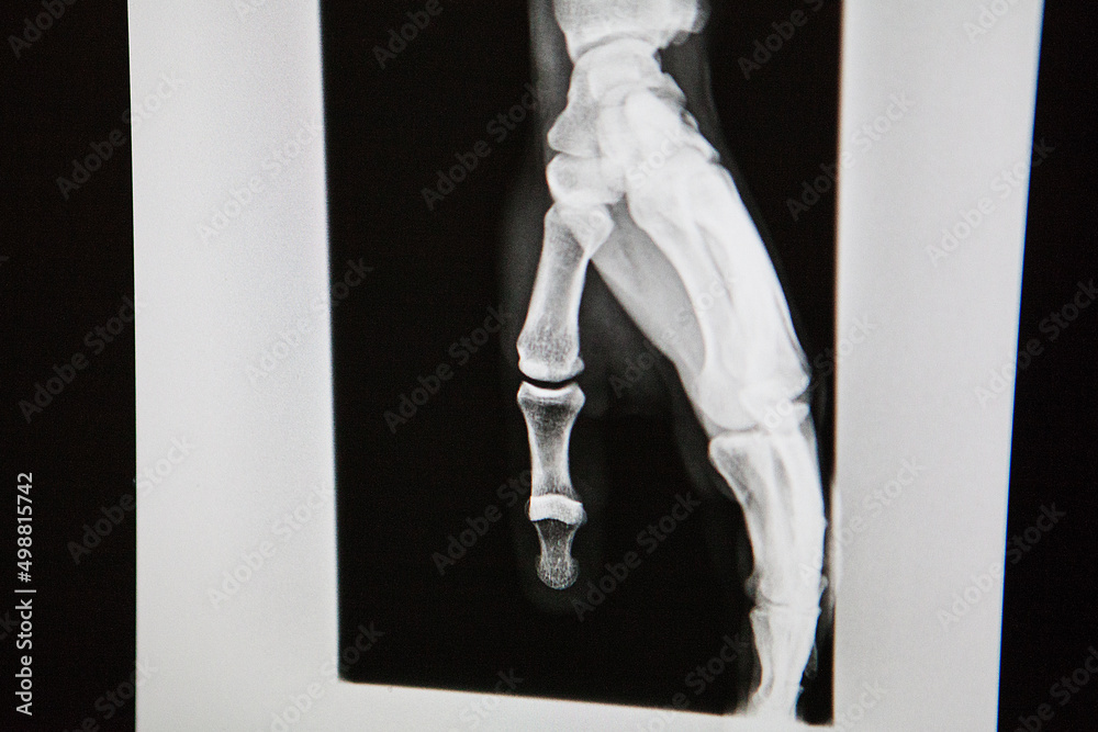 X-ray of an open dislocation of the thumb at a mountain doctor. Stock ...