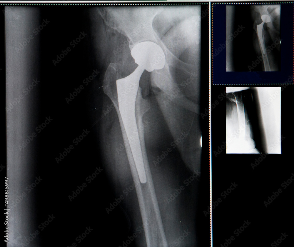 X-ray of the patient's hip after placement of the prosthesis. Stock ...