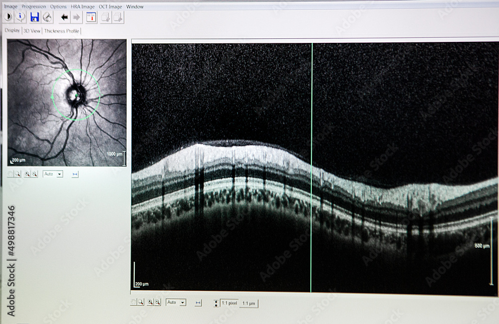 Optical coherence tomography (OCT) showing the optic nerve. Stock Photo ...