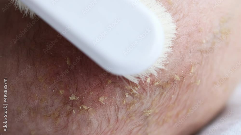 removing dandruff flakes of seborrhea from baby infant head with soft ...