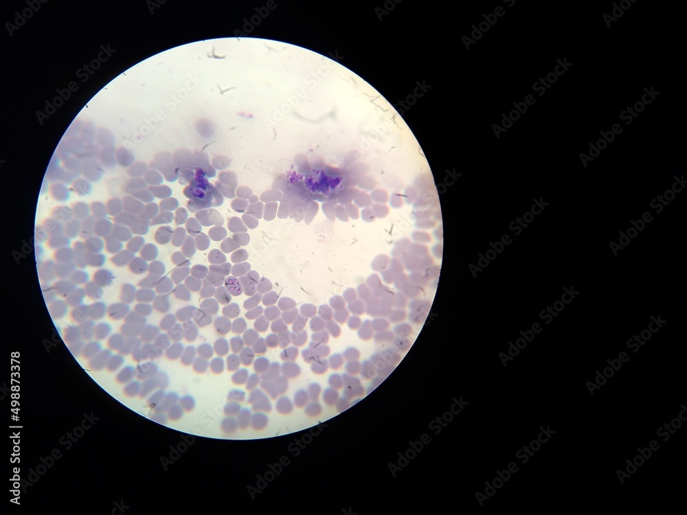 tumor cells under the microscope Stock Photo | Adobe Stock
