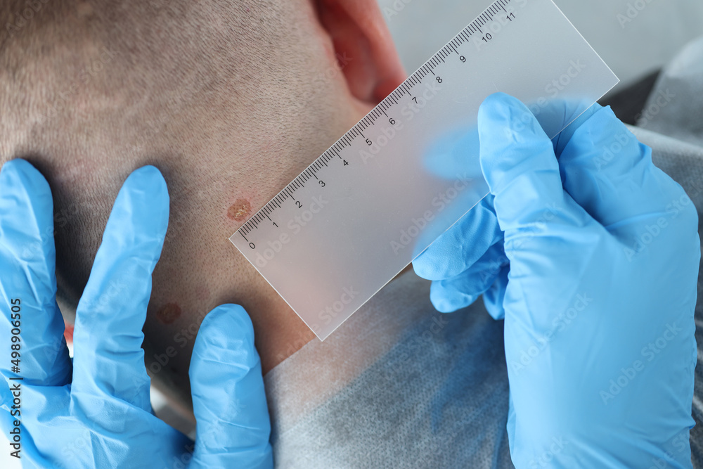 Medical worker measure with ruler mole on patient neck, man checkup ...
