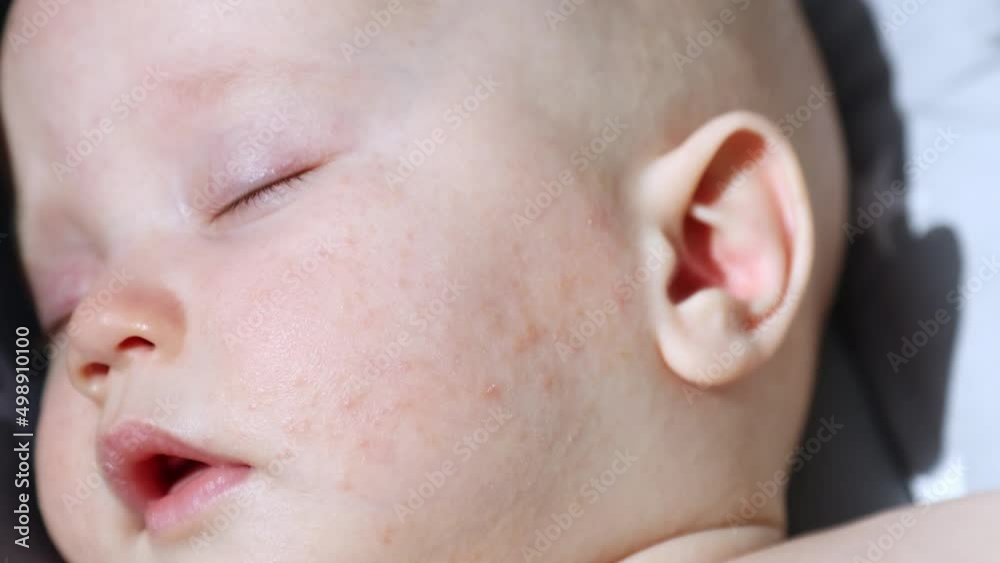 atopic dermatitis rush and allergic skin on baby infant cheek face ...