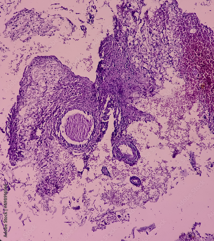 Endocervical tissue biopsy: Photomicrograph show part of ectocervix and ...