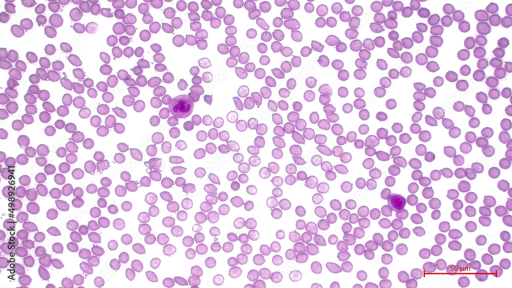 Light micrograph showing human blood cells (Blood smear). Erythrocytes ...