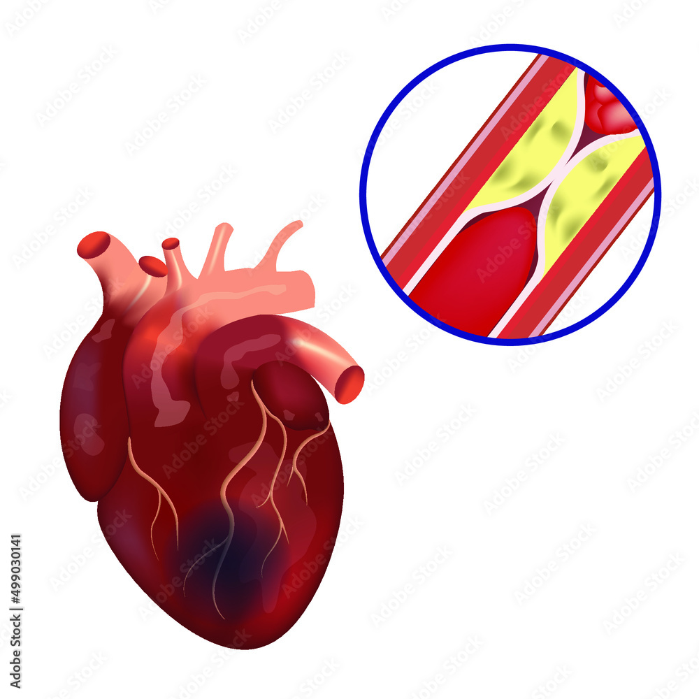 Coronary artery disease. Disease infographic. Atherosclerosis of the ...