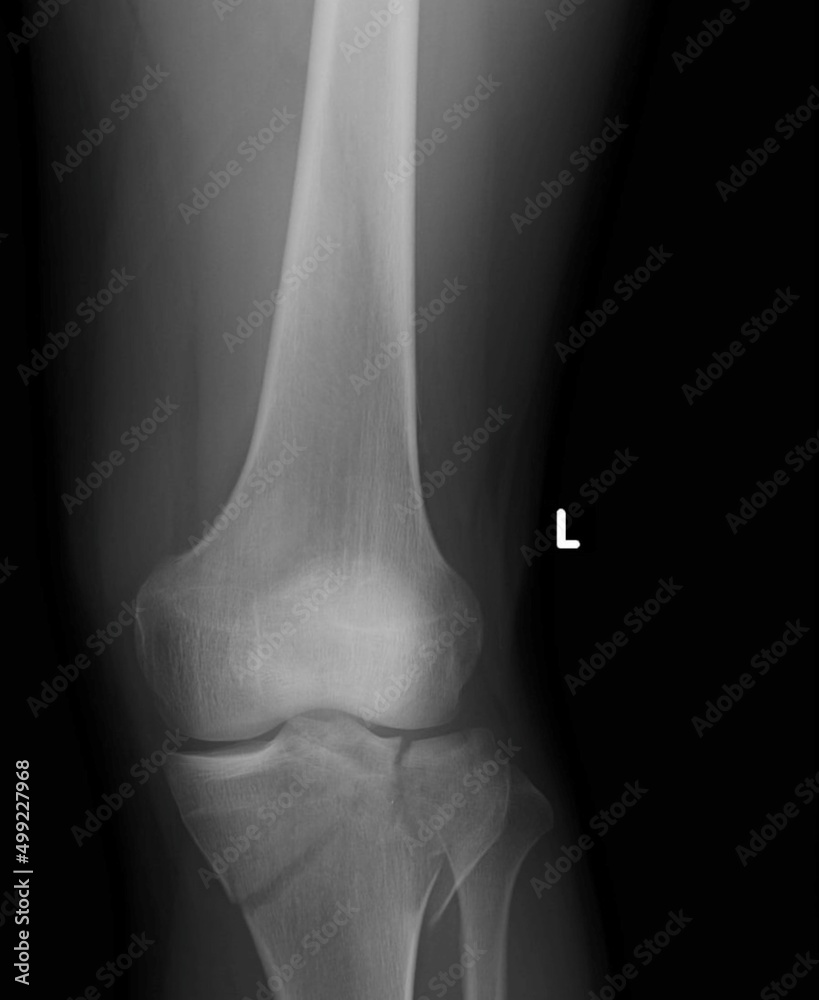 Tibial plateau fractures are break in the upper part of the shinbone ...