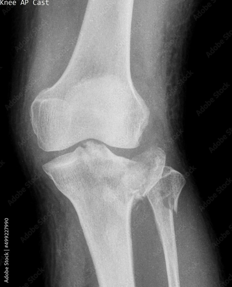 Tibial plateau fractures are break in the upper part of the shinbone ...