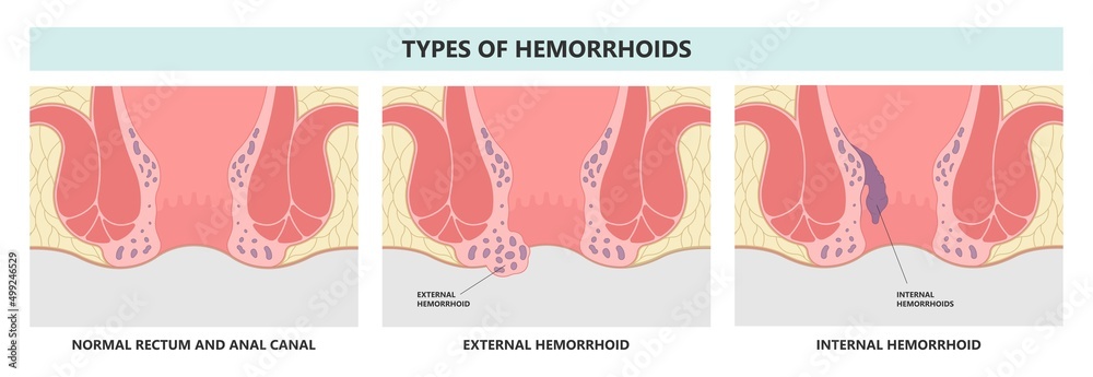 thrombectomy thrombosis fistula removal surgical Piles swollen blood ...