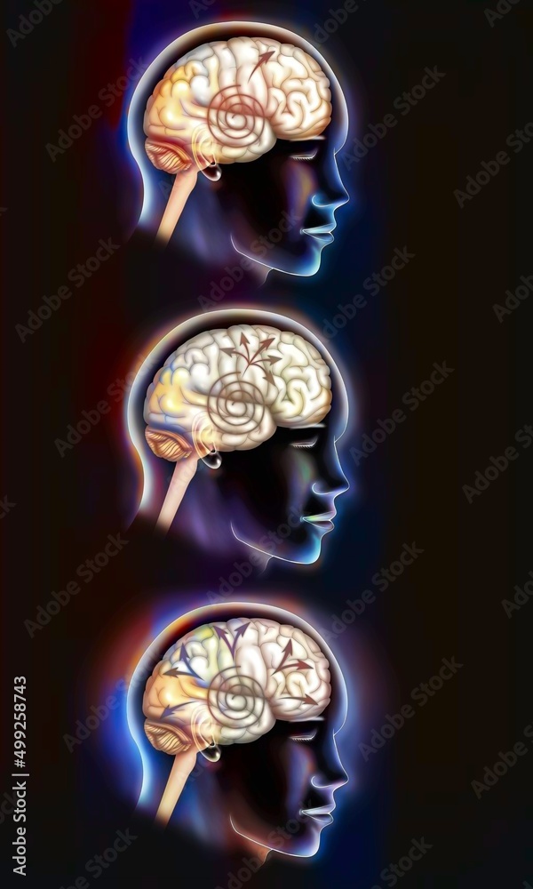 Different stages of epileptic seizure: partial seizure. Stock ...