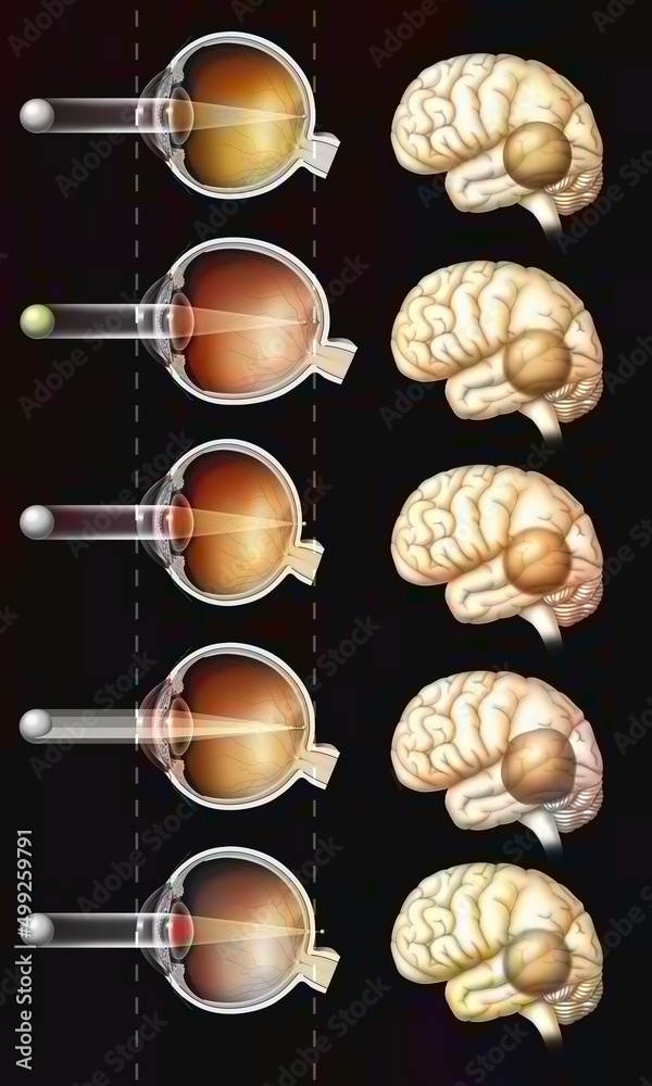 Eye: comparison between a normal eye and a myopic hyperopic. Stock ...