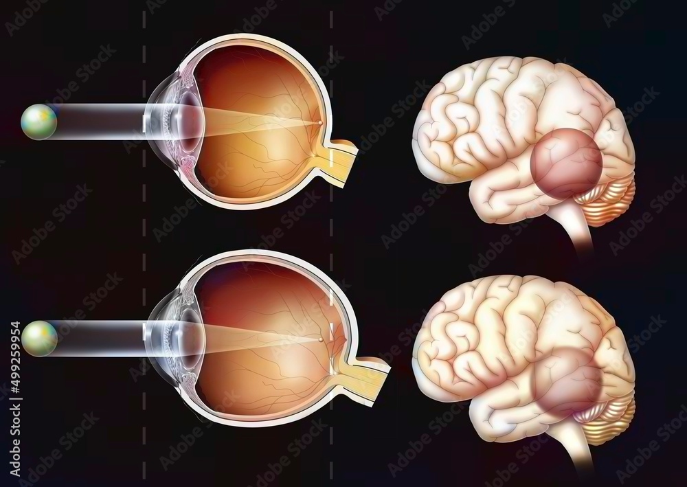 Comparison between normal vision and that of a myopic eye. Stock ...