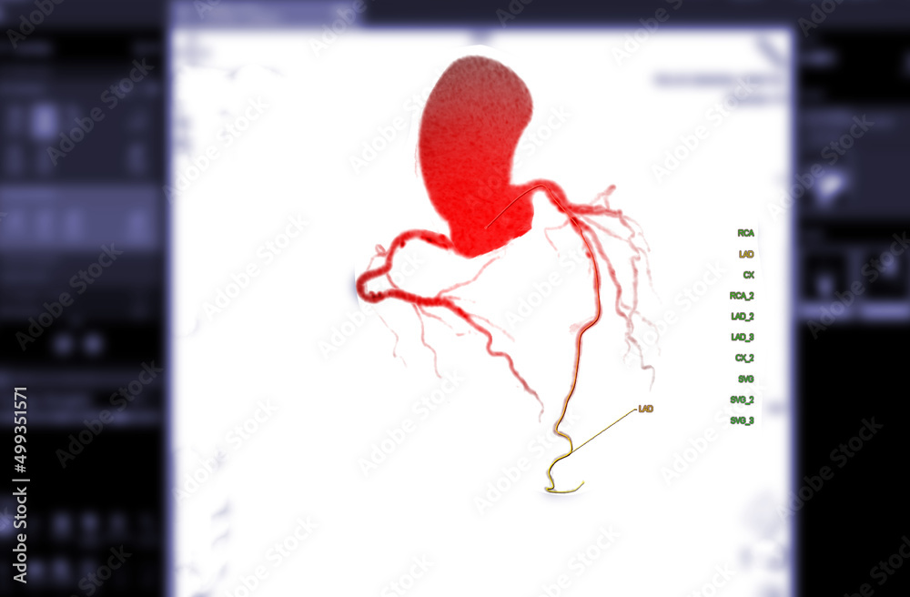 Foto de CTA Coronary artery 3D rendering image on the screen for ...