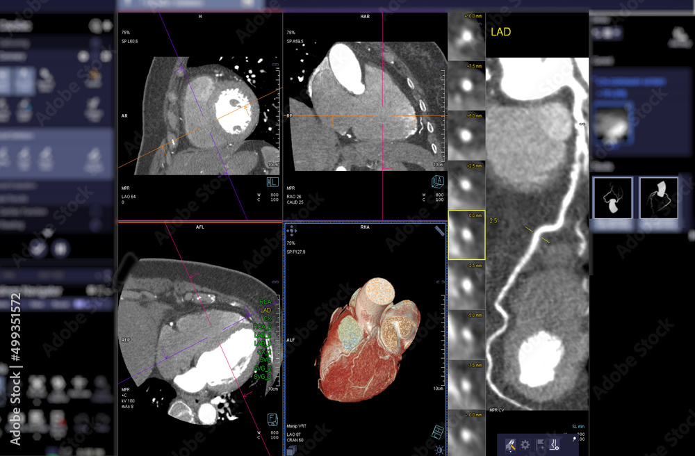 CTA Coronary artery 3D rendering image on the screen for diagnosis of ...