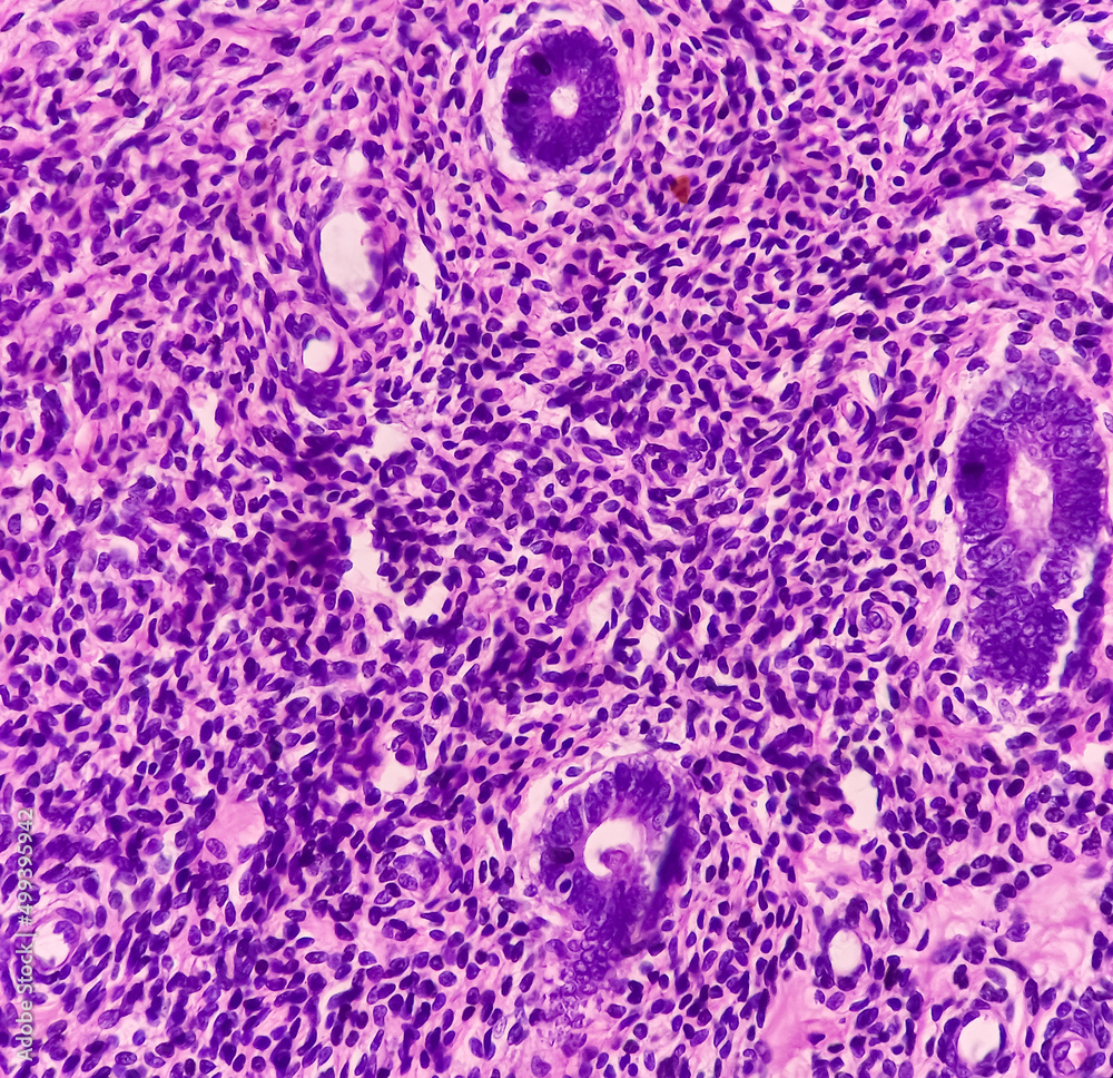 Cervix: Chronic cervicitis with prolapse, cervix show chronic ...