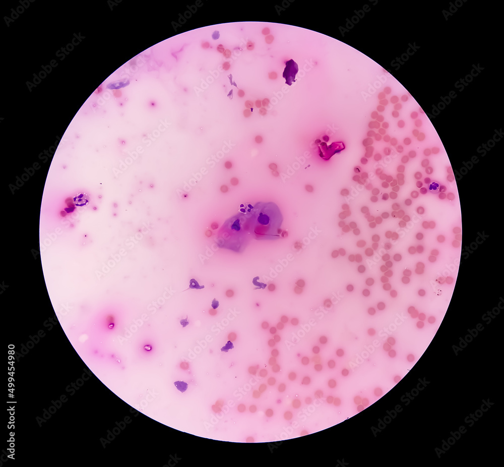 Microscopic view of vault smear showing radiation induced changes Stock ...