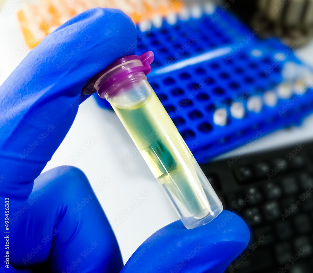 Eppendorf Tube with Cerebrospinal fluid (CSF) sample for pathological ...