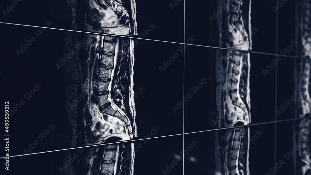 MRI Scan, Magnetic Resonance Images, of the spine Stock Photo | Adobe Stock