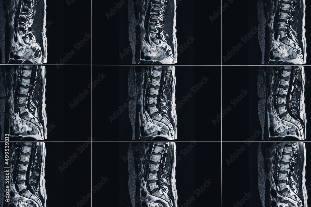 MRI images, MRI of the spine Stock Photo | Adobe Stock