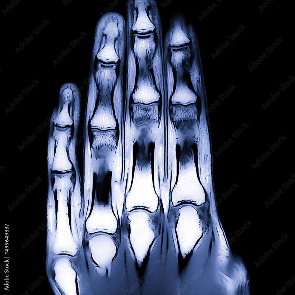 X-ray image of a hand, with bones, muscle and tissue showing. Real MRI ...
