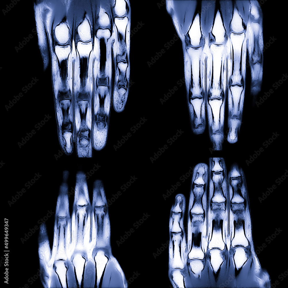 MRI X-ray image of a hand at various stages, with bones, muscle and ...