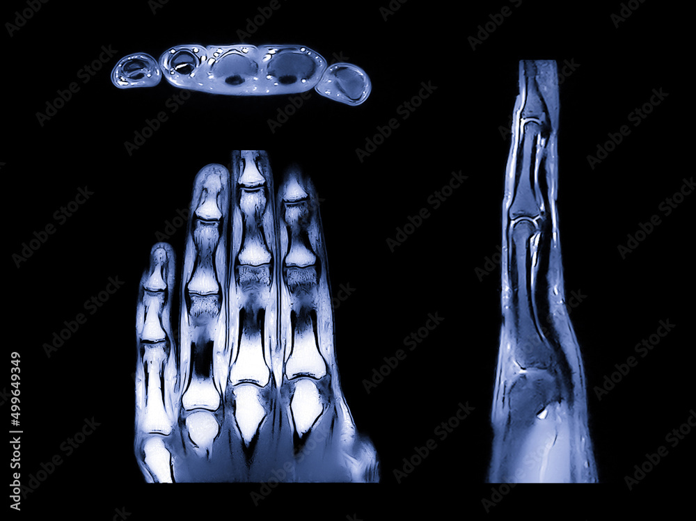 MRI X-ray image of a hand from various angles, with bones, muscle and ...