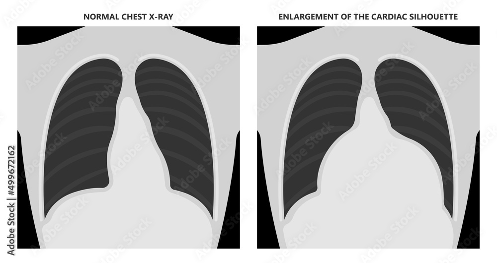 Heart attack acute chest pain injury difficulty breathing fat pads ...