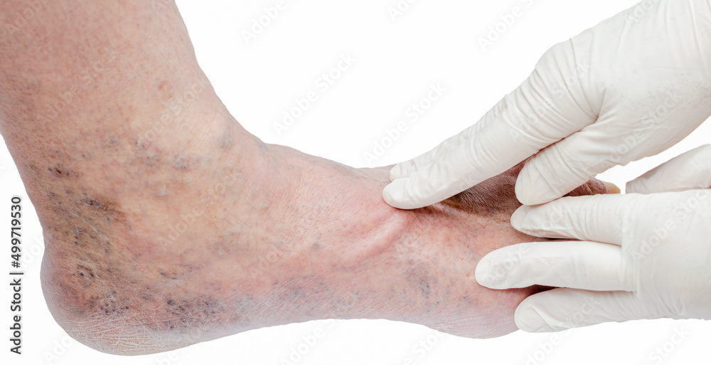 Doctor in white gloves holding man's foot and pointing to varicose ...
