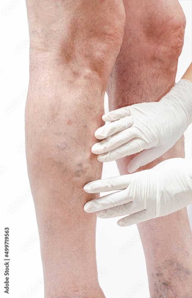 Doctor in white gloves holding man's foot and pointing to varicose ...