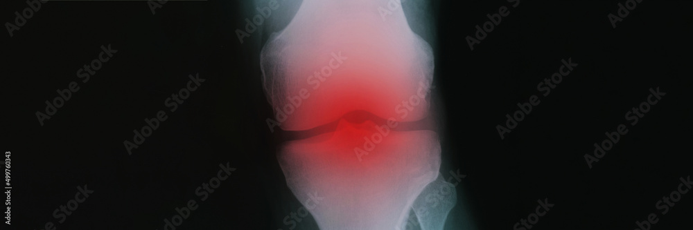 Poster X ray with red inflammation of knee joint closeup – Wall Art ...