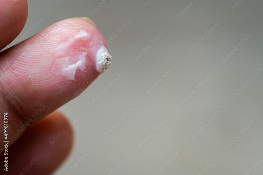 White warts on fingertips, skin disease being treated. Peeling fingers ...