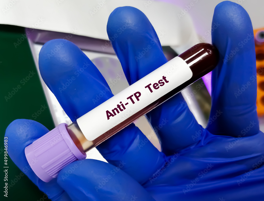 Blood sample for Anti Treponema pallidum or anti-TP test. Diagnosis ...