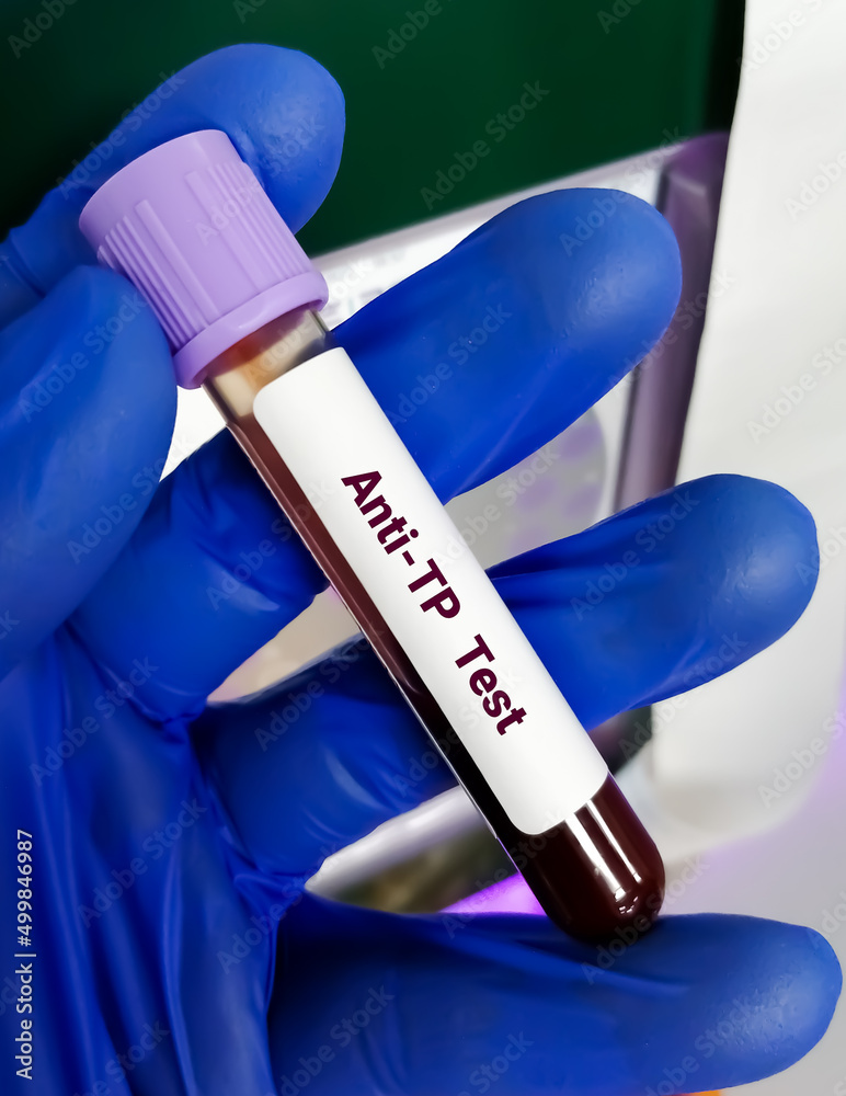 Blood sample for Anti Treponema pallidum or anti-TP test. Diagnosis ...