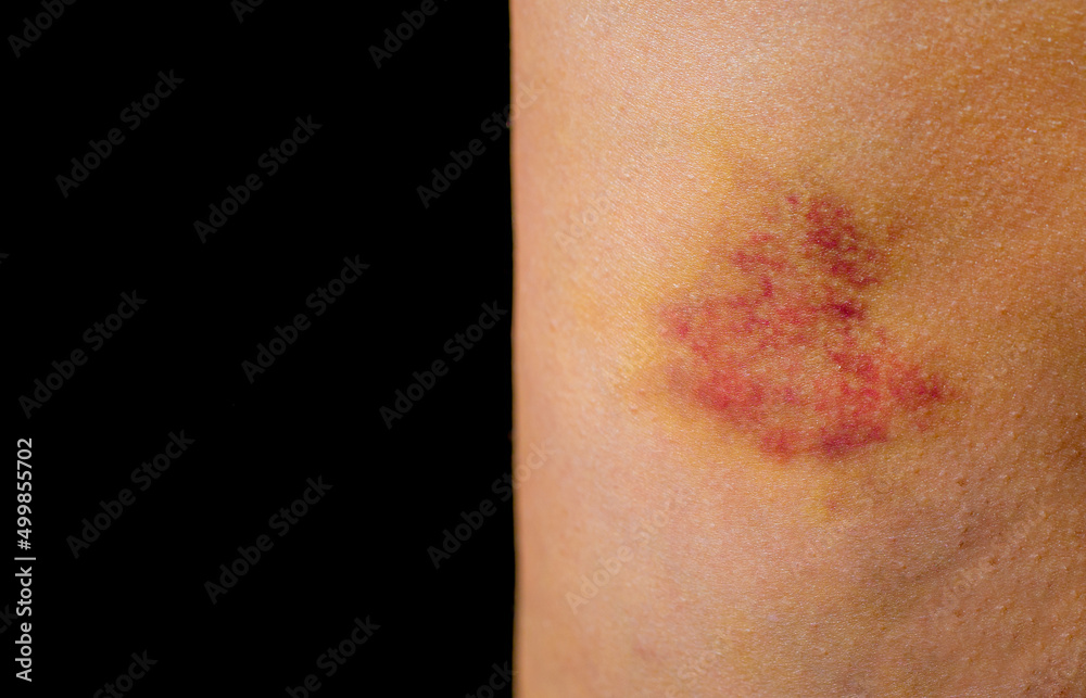 Bruises on the human body. Severe bruise from impact, bruising and ...