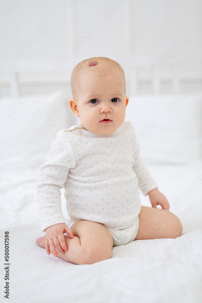a baby girl of six months with a red hemangioma or a benign tumor on ...