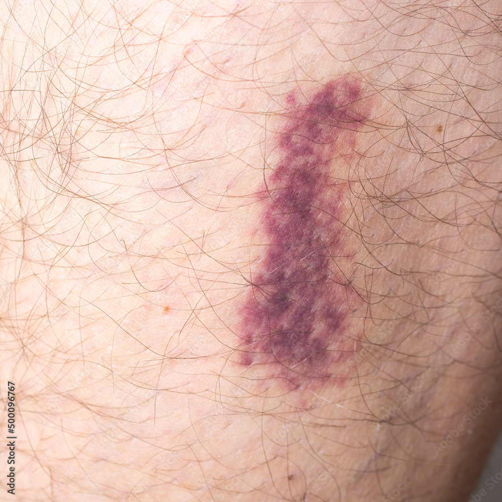 Bruise on leg close up. Stock Photo | Adobe Stock