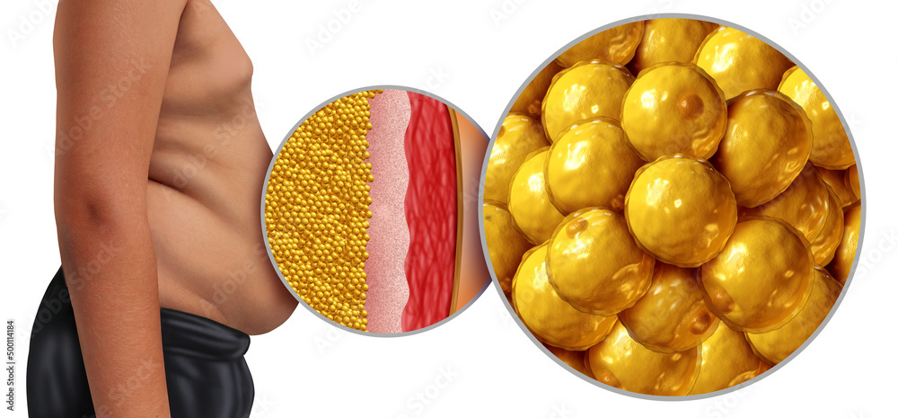 Obesity and fat cells or adipocyte concept as a belly of an obese ...