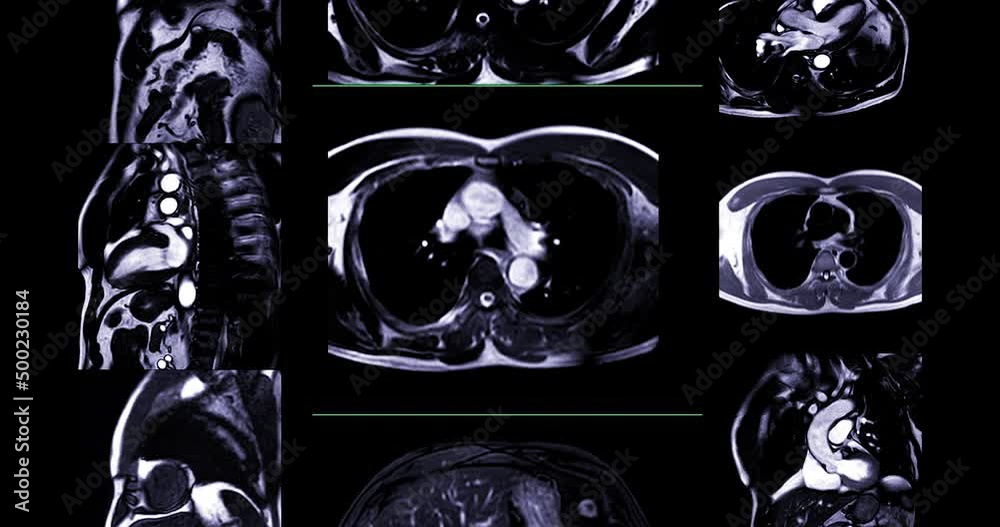MRI heart or Cardiac MRI ( magnetic resonance imaging of heart ...
