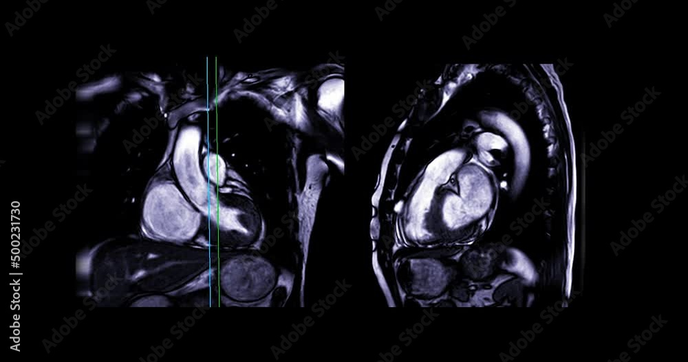 Video Stock MRI heart or Cardiac MRI ( magnetic resonance imaging of ...