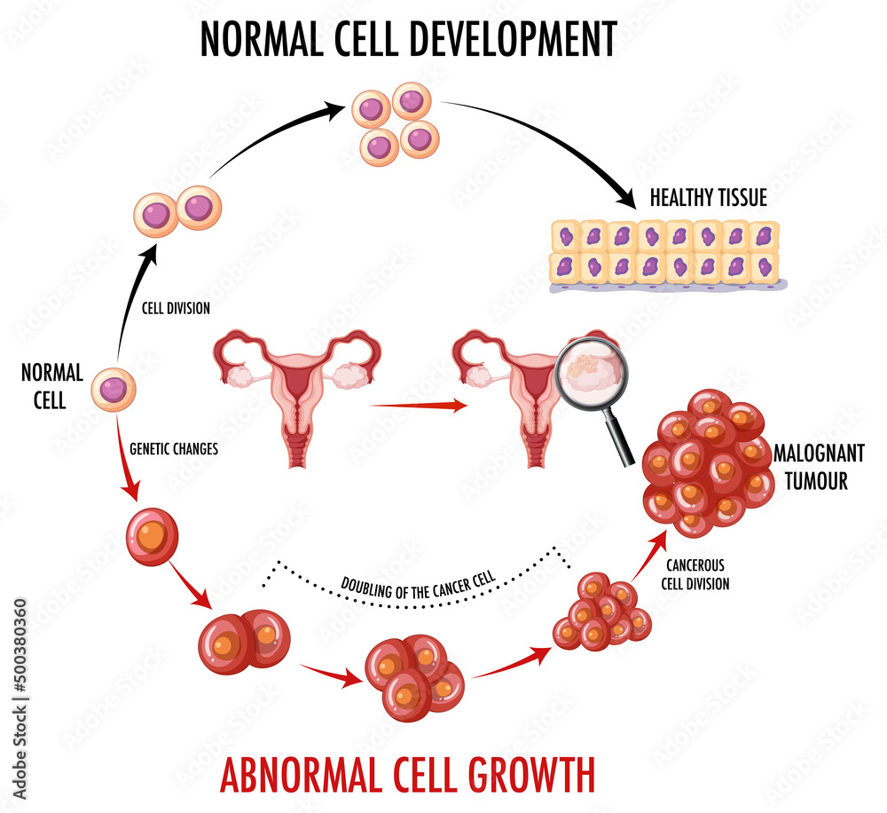 Diagram showing cancer development process Stock Vector | Adobe Stock