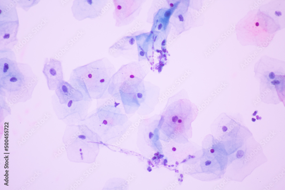 View in microscopic of Candidiasis, fungus infection (Yeast and ...
