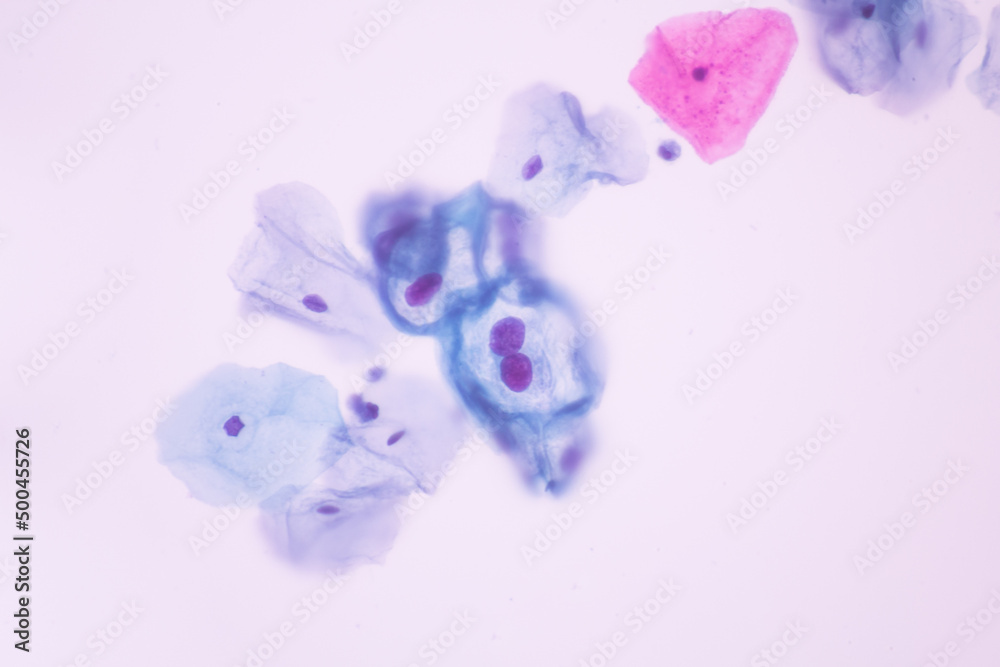 Abnormal squamous epithelial cells view in microscopy.HPV criteria for ...