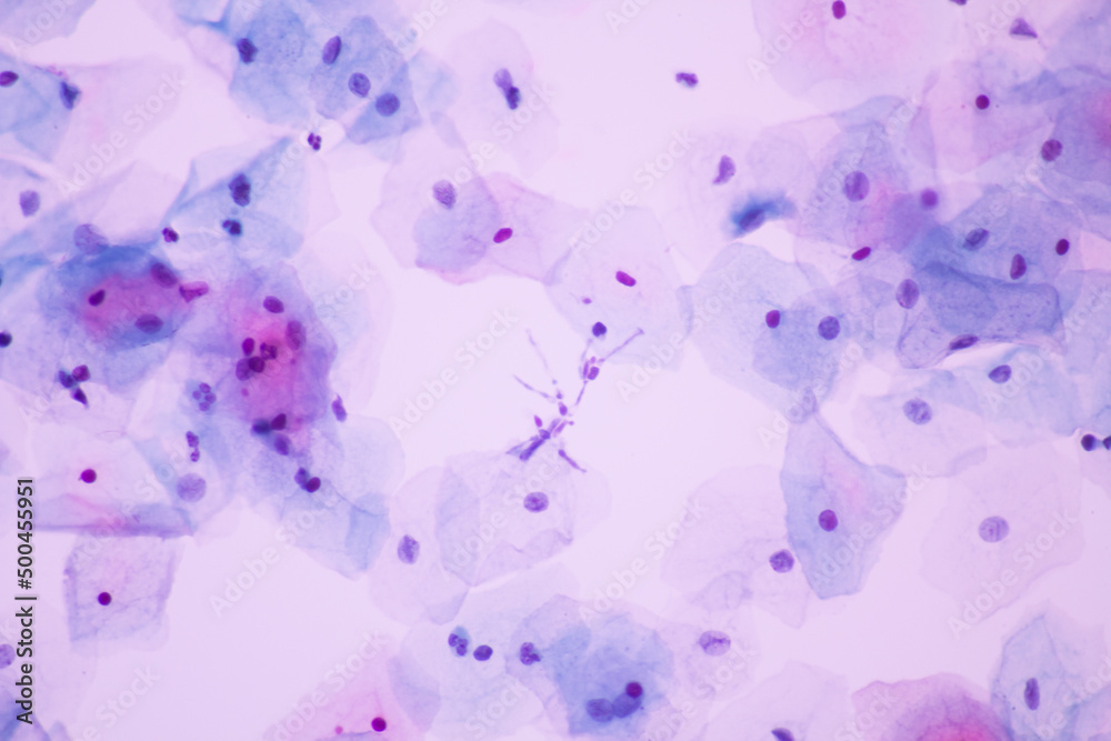 View In Microscopic Of Candidiasis Fungus Infection Yeast And